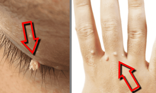 Natuurlijke middelen om wratten te verwijderen - BESCHERMT UW GEZONDHEID